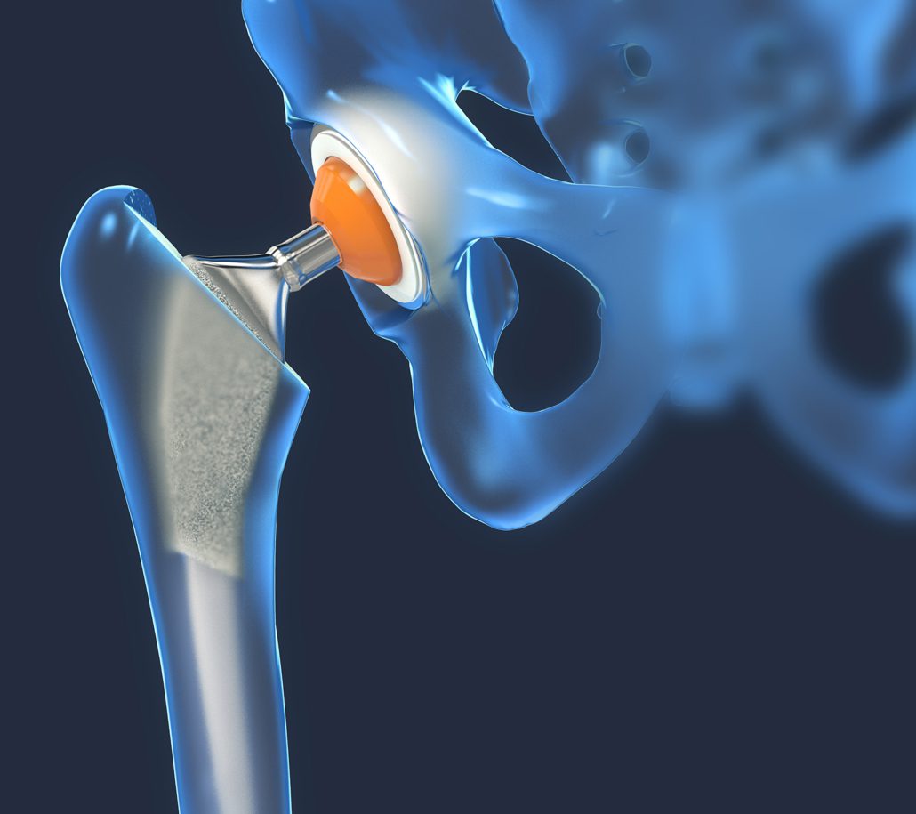 Hip Replacement - Gavin Love Orthopaedic Surgeon
